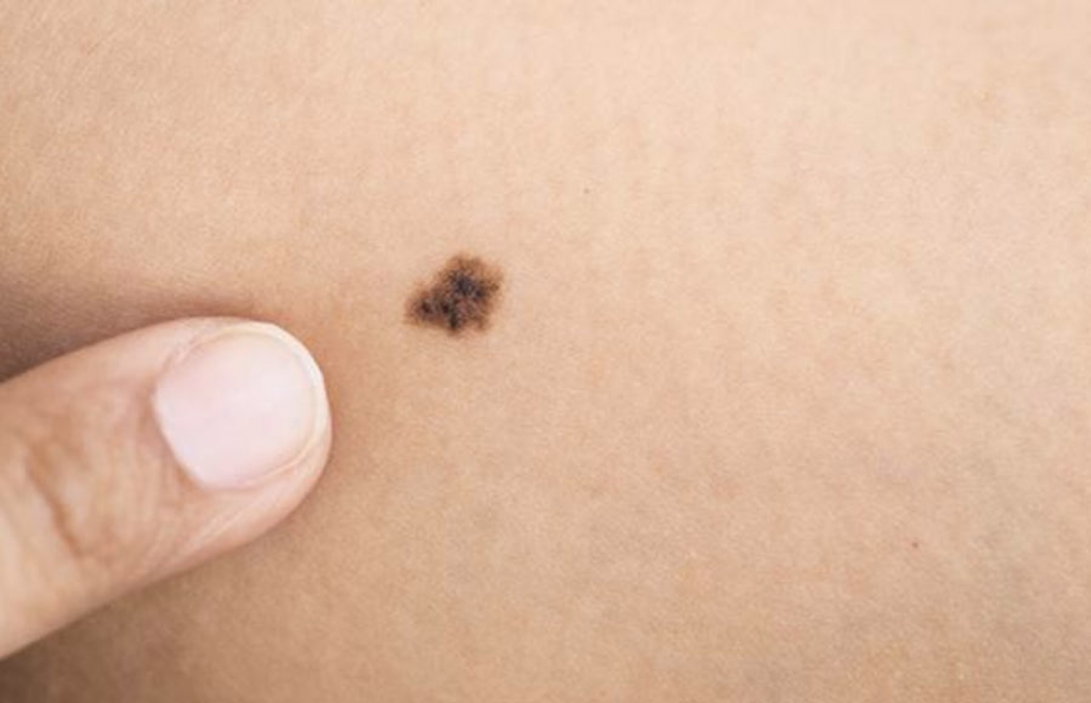 Spoletonline | Prevenzione melanoma: fondamentali auto-osservazione e ... Spoletonline | Prevenzione melanoma: fondamentali auto-osservazione e ...